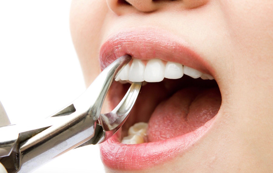 Tooth Extraction - Kavita Dental Care